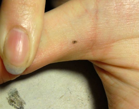 La gran mayoría de lunares en el pie o mano son benignos - Unicas